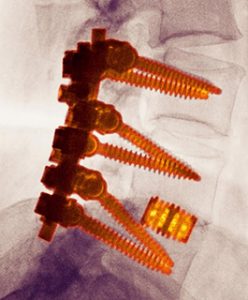 Lumbar Discseel® Spine Treatment - Regenerative Spine And Joint