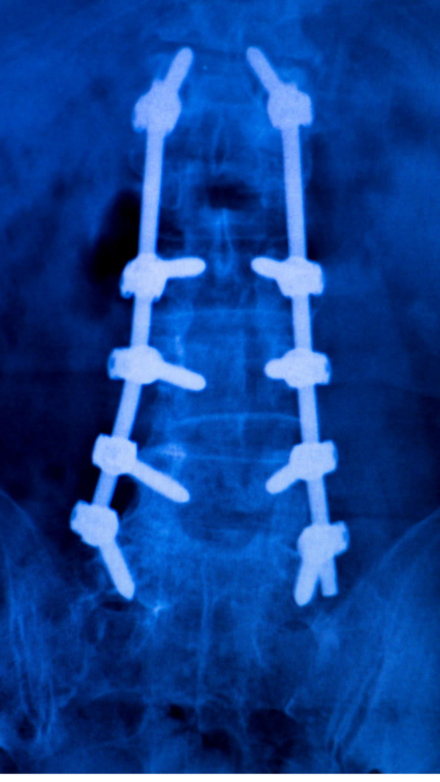 The Unintended Consequence of Lumbar Fusion Surgery - Regenerative ...