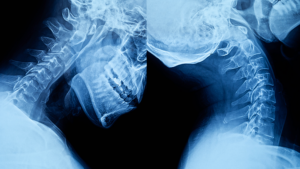 Cervical Radiofrequency Ablation (RFA) Neurotomy - Regenerative Spine ...