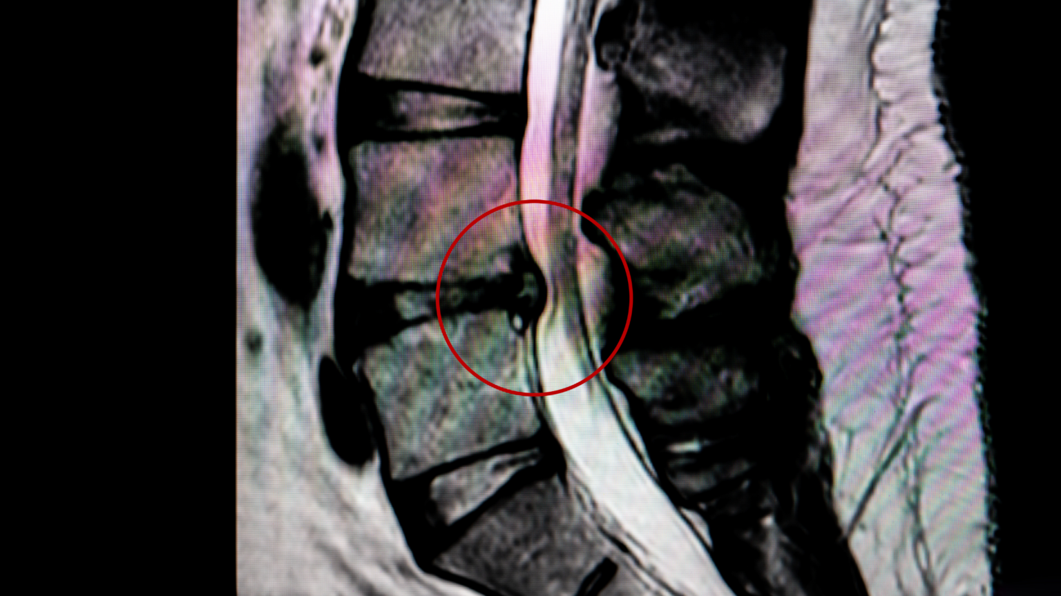MRI Detection of Lumbar Disc Protrusions - Regenerative Spine And Joint